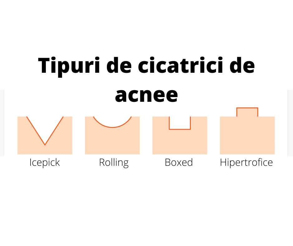 Cicatrici de acnee: clasificare si optiuni de tratament | Skin Clinic