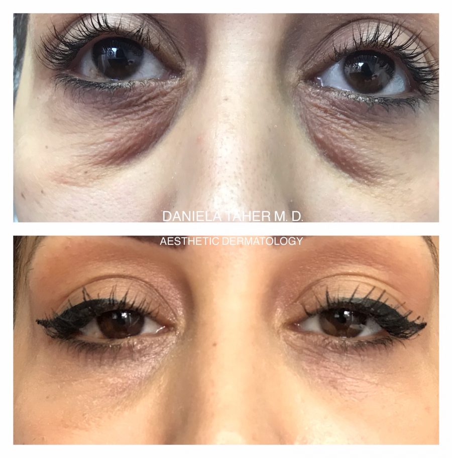 Injectii cu acid hialuronic – Skin Clinic